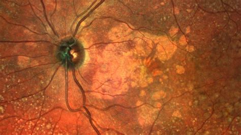 Tomografia Ottica A Coerenza Di Fase Oct Che Cosè