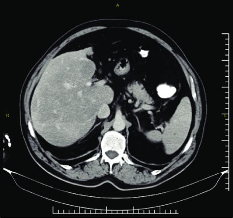 Computed Tomography Of The Abdomen Showed Nodularity Of The Surface Of