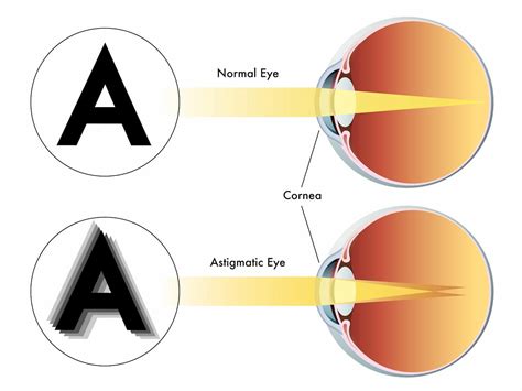 What Does Astigmatism Look Like Oculus Eyecare Seattle Optometrist
