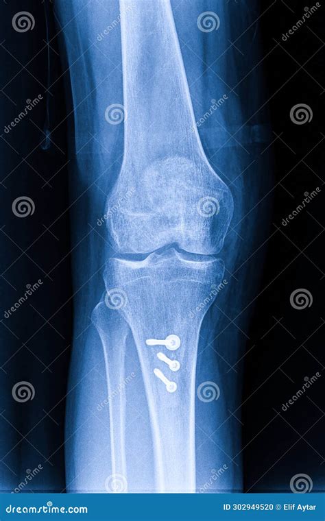 Fix Proximal Tibia Stock Image CartoonDealer Com
