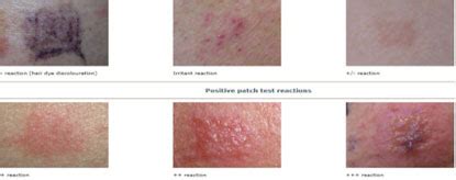 Allergy Patch Testing QSD