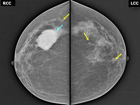 Atlas Of Breast Cancer Early Detection