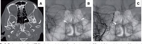 Figure 1 From Trigeminal Neuralgia Caused By Dural Arteriovenous Fistula Of The Transverse
