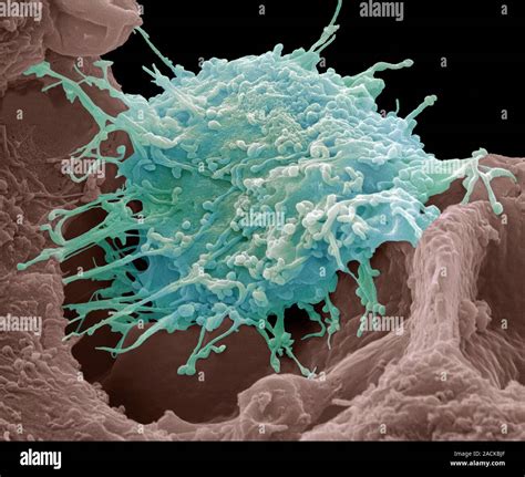 Cervical Cancer Cell Coloured Scanning Electron Micrograph Sem Of A Cultured Cancer Cell From