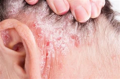 Apremilast For Plaque Psoriasis Of The Body And Scalp Dermatology Advisor