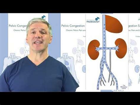 Pelvic Congestion Syndrome Explained With Animations Artofit