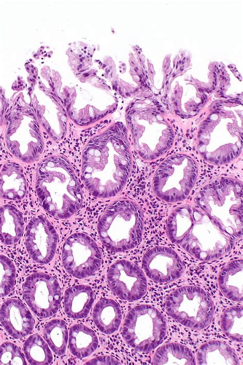 Hyperplastic Polyp Libre Pathology