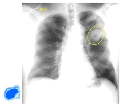 Cxr Cavity In Lung Ppt