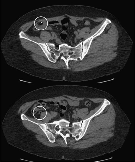 Abdomino Pelvic Ct At 48 Hours Migration Of The Appendicolith Into The Download Scientific