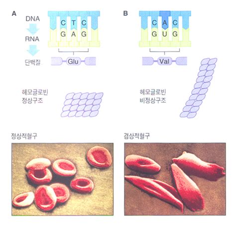 겸상적혈구 빈혈증에서 나타나는 돌연변이 네이버 블로그