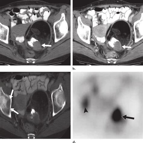 Monodermal Teratoma Struma Ovarii In A 46 Year Old Woman A B Download Scientific Diagram