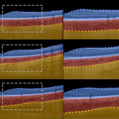 Example Segmentation Outputs From The R2 U Net 3 Layer Variant For