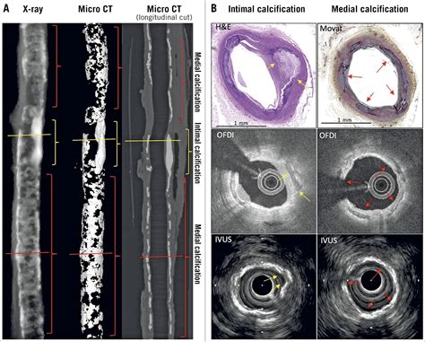 Intravascular Imaging And Histological Correlates Of Medial And Intimal Calcification In