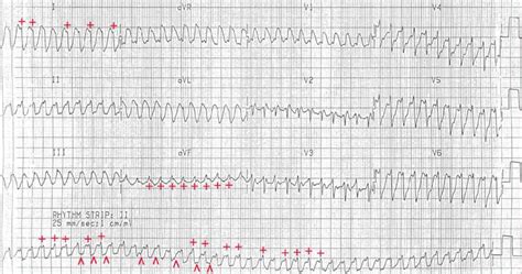 Ventricular Fibrillation Rhythm Strip