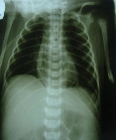 Ngt In Fundus Of Stomach