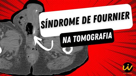 Sindrome De Fournier Imagens Retoedu