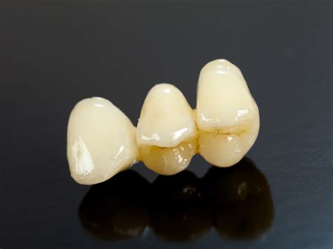 3 Tooth Solution For A 1 Tooth Problem General And Cosmetic