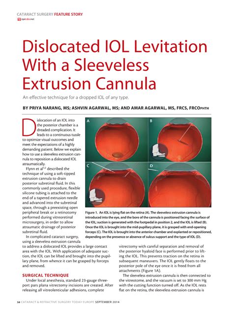 Dislocated Iol Levitation With A Sleeveless Extrusion Cannula An
