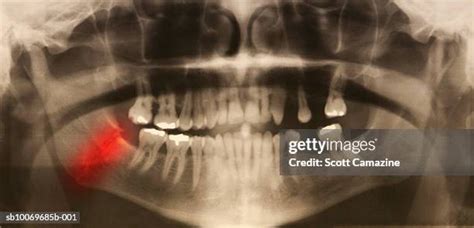 Skull Broken Jaw Photos And Premium High Res Pictures Getty Images