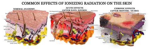Ionizing Radiation Exposure Radiation Exposure Nuclear