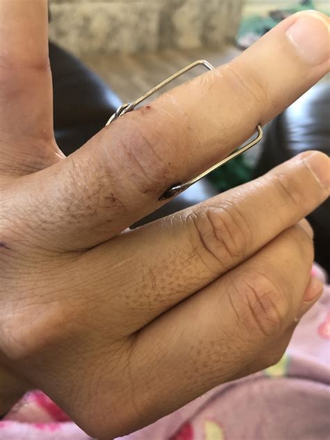 Pip Pilon Fracture Hardware After Surgery R Medizzy