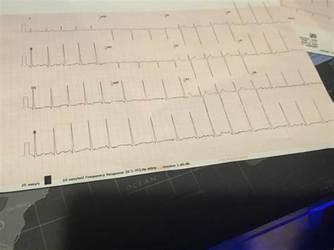 Ekg Borderline Reported Is There Anything Else Rmedicaladvice