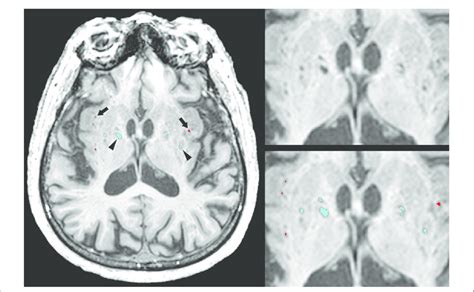 Enlarged Virchow Robin Space Vrs Segmentation With White Matter Vrs Download Scientific
