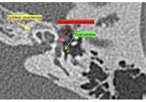Otosclerosis