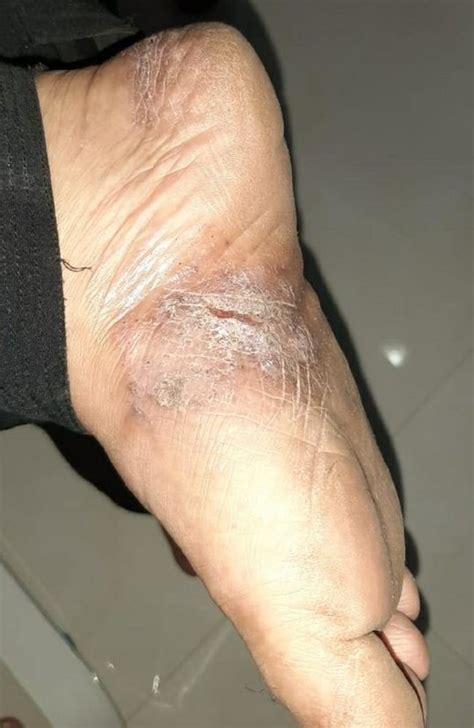 Palmoplantar Pustulosis Differential Diagnosis