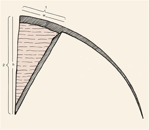 7 Rotation Flaps Pocket Dentistry