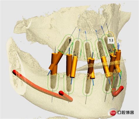 全口无牙颌种植病例 数字化种植中心的博客 KQ88口腔博客