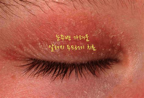 눈주변 가려움 알러지 두드러기 치료