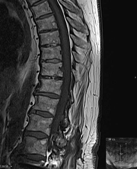 Disc Space Narrowing And Osteophytes Clinical Tree