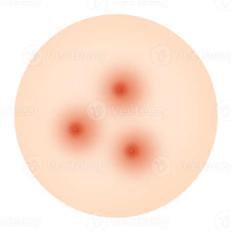 Acne Care Illustration Skin With Acne Issues Acne Types Clipart