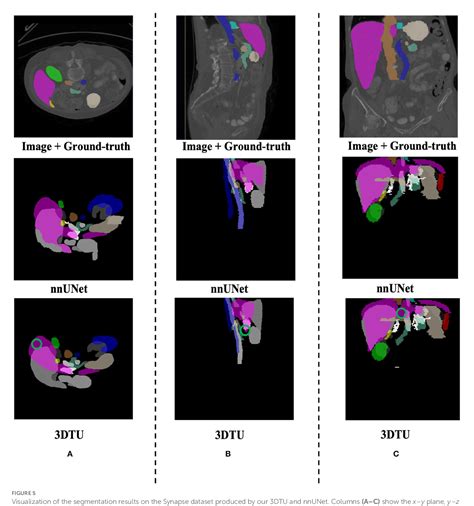 Figure 1 From 3d Bi Directional Transformer U Net For Medical Image