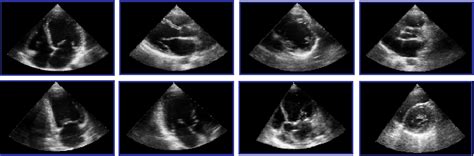 Figure 1 From Echocardiogram View Classification Using Edge Filtered