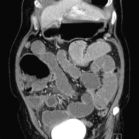 Pdf A Case Report Cecal Volvulus Caused By Meckels Diverticulum