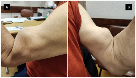 Popeye Deformity A Red Flag For Wild Type Transthyretin Amyloidosis