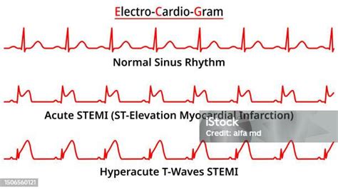 Set Of Ecg Common Abnormalities Acute Hyperacute Stemi Normal Sinus