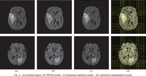 Figure 2 From Automatic Brain Tumor Segmentation Based On Features Of