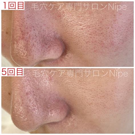 皮むけする程乾燥しているのにベタベタする鼻が 『変わらない毛穴はない』長年の毛穴悩みから卒業できる。毛穴ケアの専門家鎌田美智子のブログ