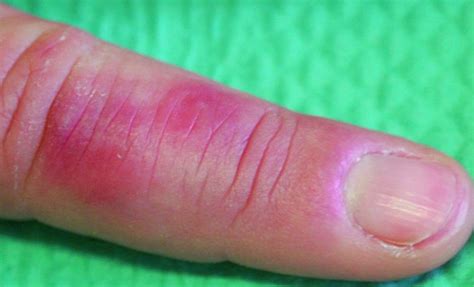 Image Chilblains Pernio Finger Msd Manual Consumer Version