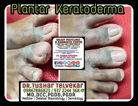 Pin On Pulmoplantar Keratoderma