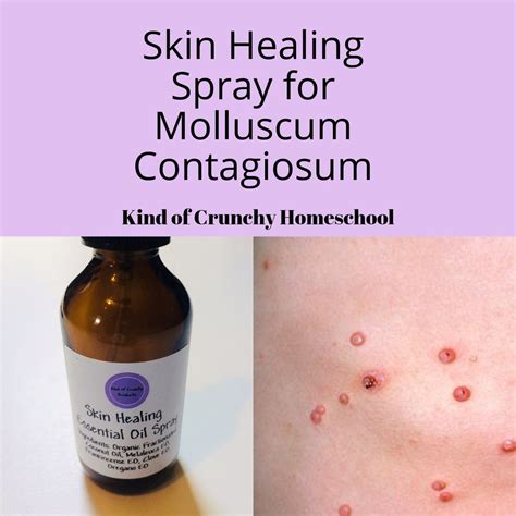 Best 12 6 Home Remedies For Molluscum Contagiosum And How To Use Them