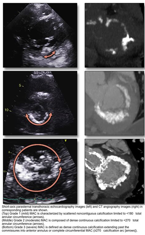 Valvular Emergencies Diagnosis And Management Of Severe Mitral