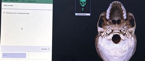Solved Show Me ﻿the Styloid Process Of Temporal Bone