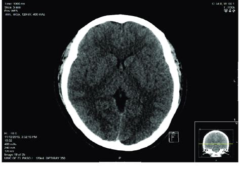 Computed Tomography Ct Head And Brain Without Contrast Is Negative