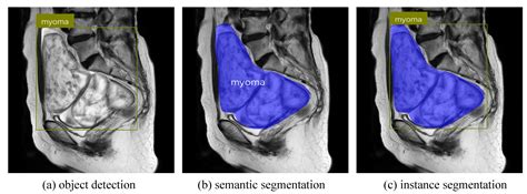 An Instance Segmentation Model Based On Deep Learning For Intelligent Diagnosis Of Uterine