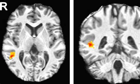 Scans Reveal Brain Activity Responsible For Decoding Facial Expressions