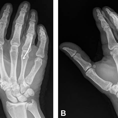 Stabilization Of The MCP Joint With External Fixator After Combined Download Scientific Diagram